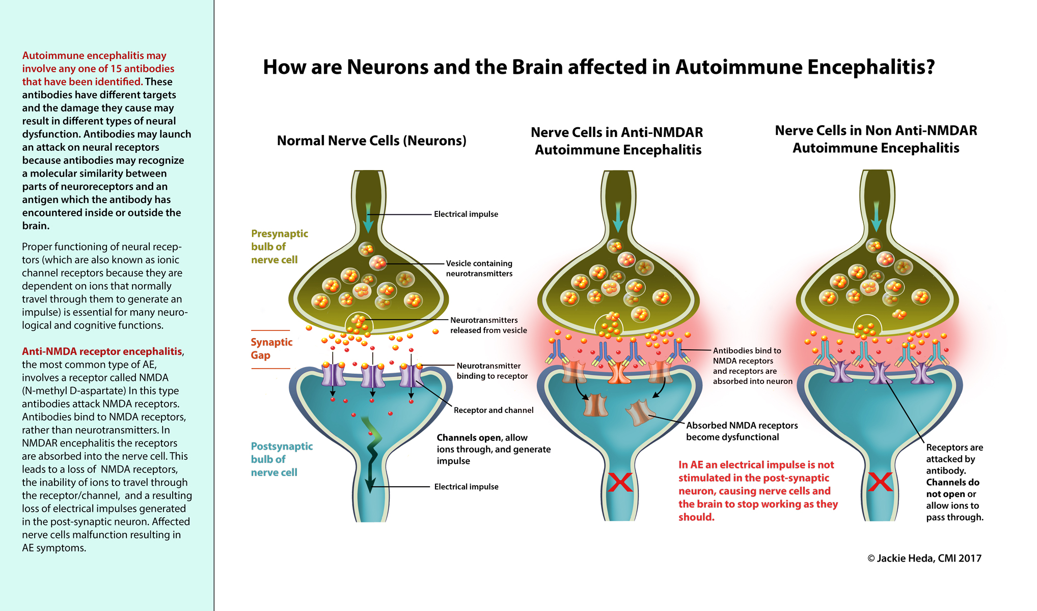 Anti NMDAR Encephalitis Archives Jackie Heda Biomedical